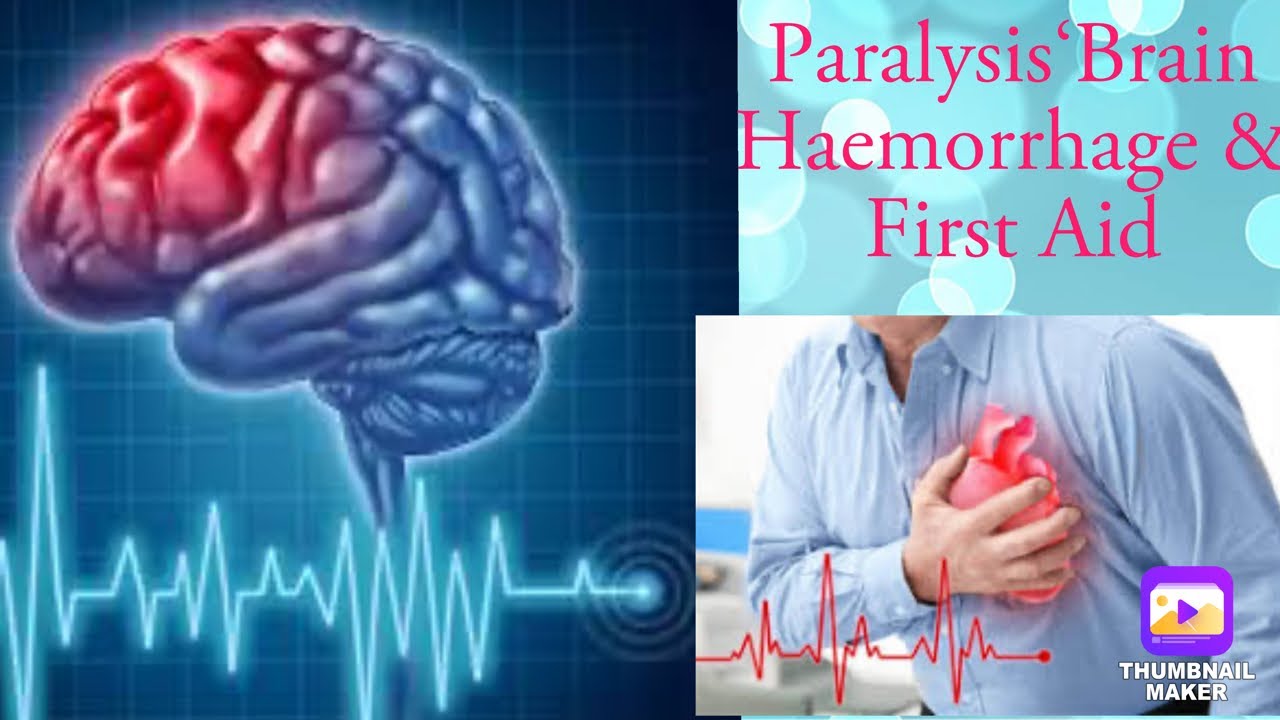 Paralysis Brain Haemorrhage & First Aid | #Medical #BrainHaemorrhage ...