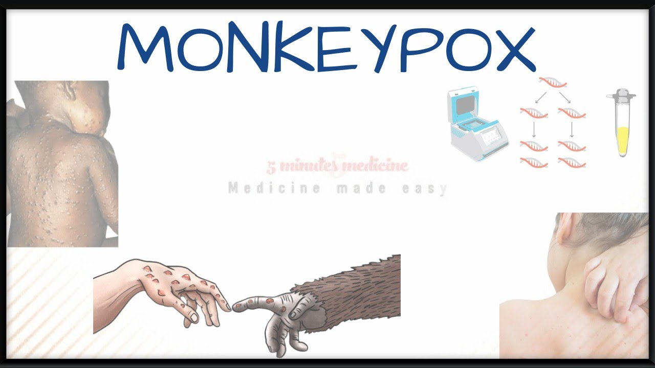 MONKEYPOX- Causes, routes of transmission, diagnosis, prevention ...