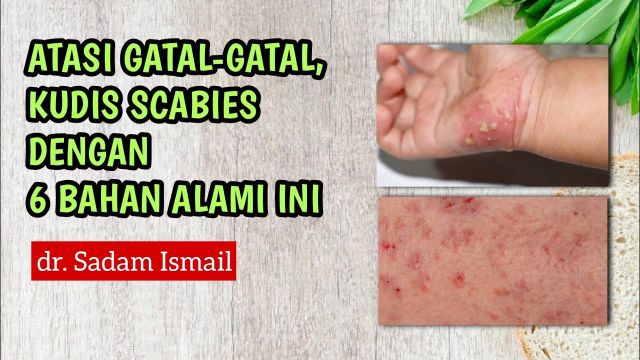 Atasi Gatal-gatal Kudis Scabies atau Gudikan Dengan 6 Bahan Alami - YouTube