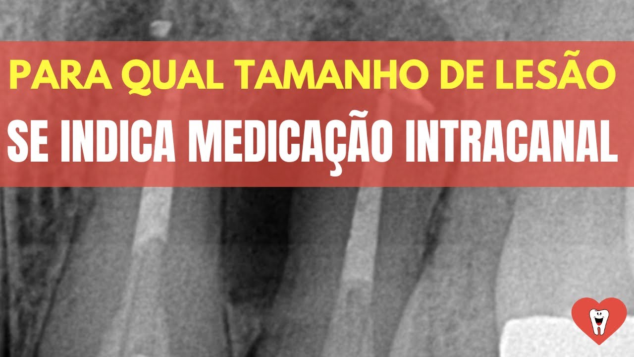 PARA QUAL TAMANHO DE LESÃO APICAL SE INDICA DEIXAR MEDICAÇÃO INTRACANAL ...