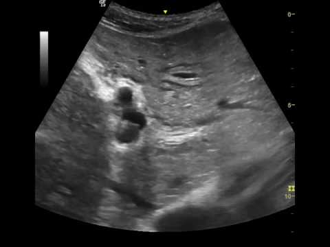 close up of lots of periportal fibrosis - YouTube