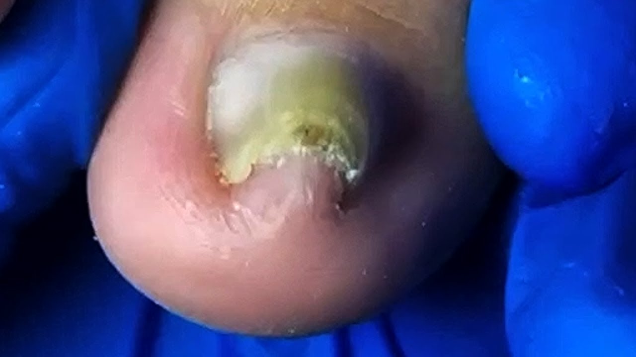 Extremely curved toenails【Magic Knife】 - YouTube