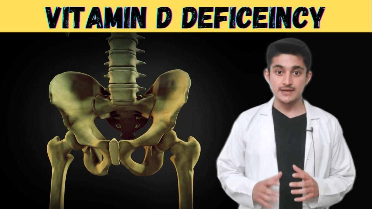 Osteomalacia 3d animation | Vitamin D function deficiency | cause ...