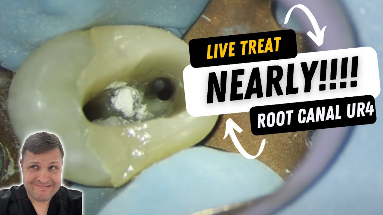 A CLOSE CALL!! - LIVE ROOT CANAL | 4K resolution - YouTube