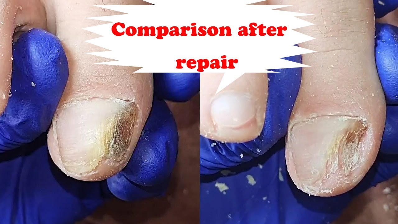 Pedicure makeover to remove bad nail | Satisfying video - YouTube