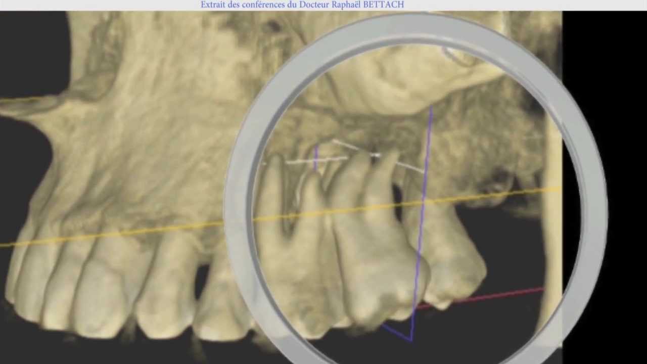 CONE BEAM DENTAIRE 3D DR RAPHAEL BETTACH NUM RX RONQUEROLLES - YouTube