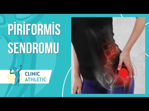 Piriformis Sendromu Nedir? | Ağrı İçin Neler Yapabiliriz?