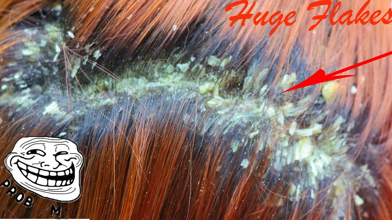 Dry Scalp, Big Flakes, Dandruff combing with my Sister's Ranking ...