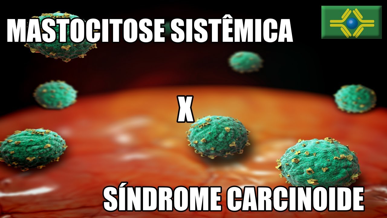 Como diferenciar MASTOCITOSE SISTÊMICA da SÍNDROME CARCINOIDE ...