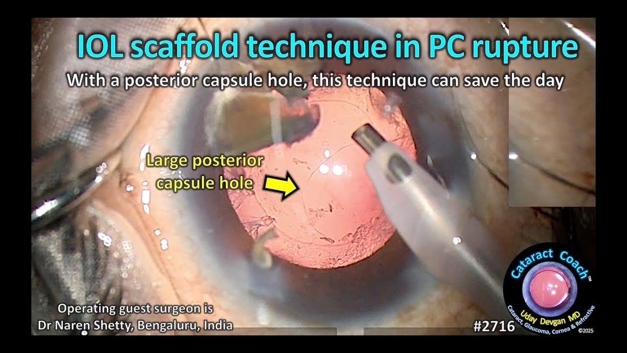 CataractCoach™ 2716: IOL scaffold technique in posterior capsule ...