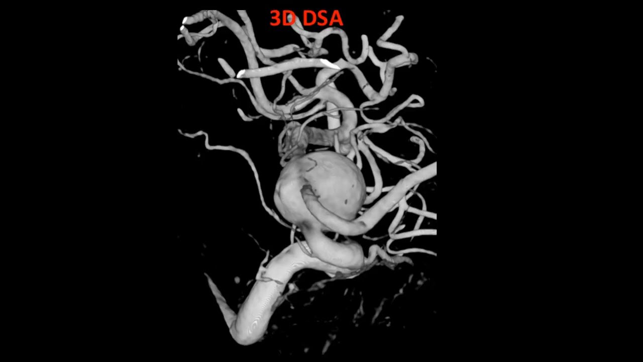 Large Fusiform Aneurysms of ICA: flow diverter treatment - YouTube