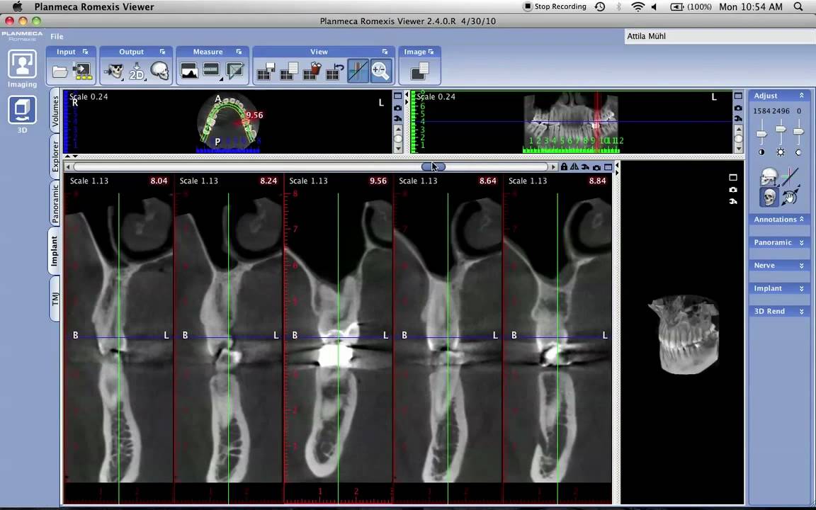 Planmeca Promax 3D CT Implant Direct Komlo Dr. Mühl - Hungary - YouTube