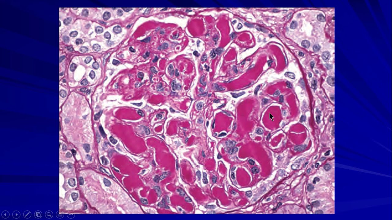 25 Renal Pathology Case 14 - YouTube