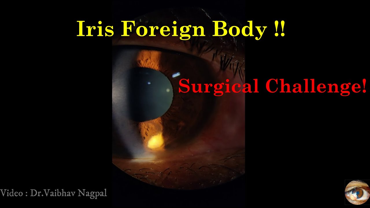 Embedded Iris Foreign body : Surgical approach : Tips to remove FB - Dr ...