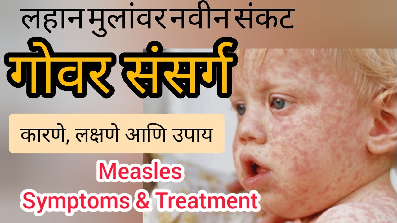 गोवर : काय आहे हा संसर्ग? | कारणे, लक्षणे, उपचार आणि गैरसमज | Measles ...