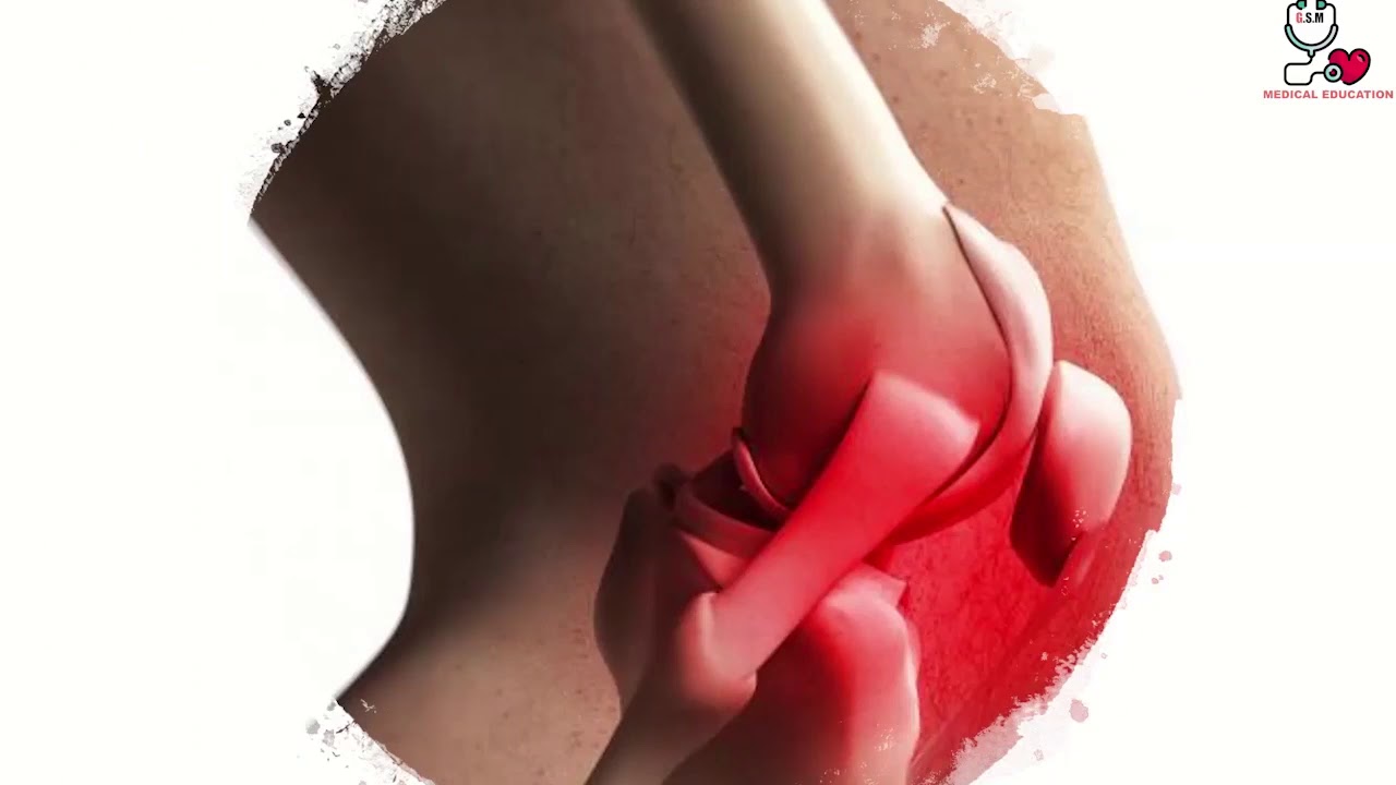 27-Prepatellar Bursitis 1 - YouTube