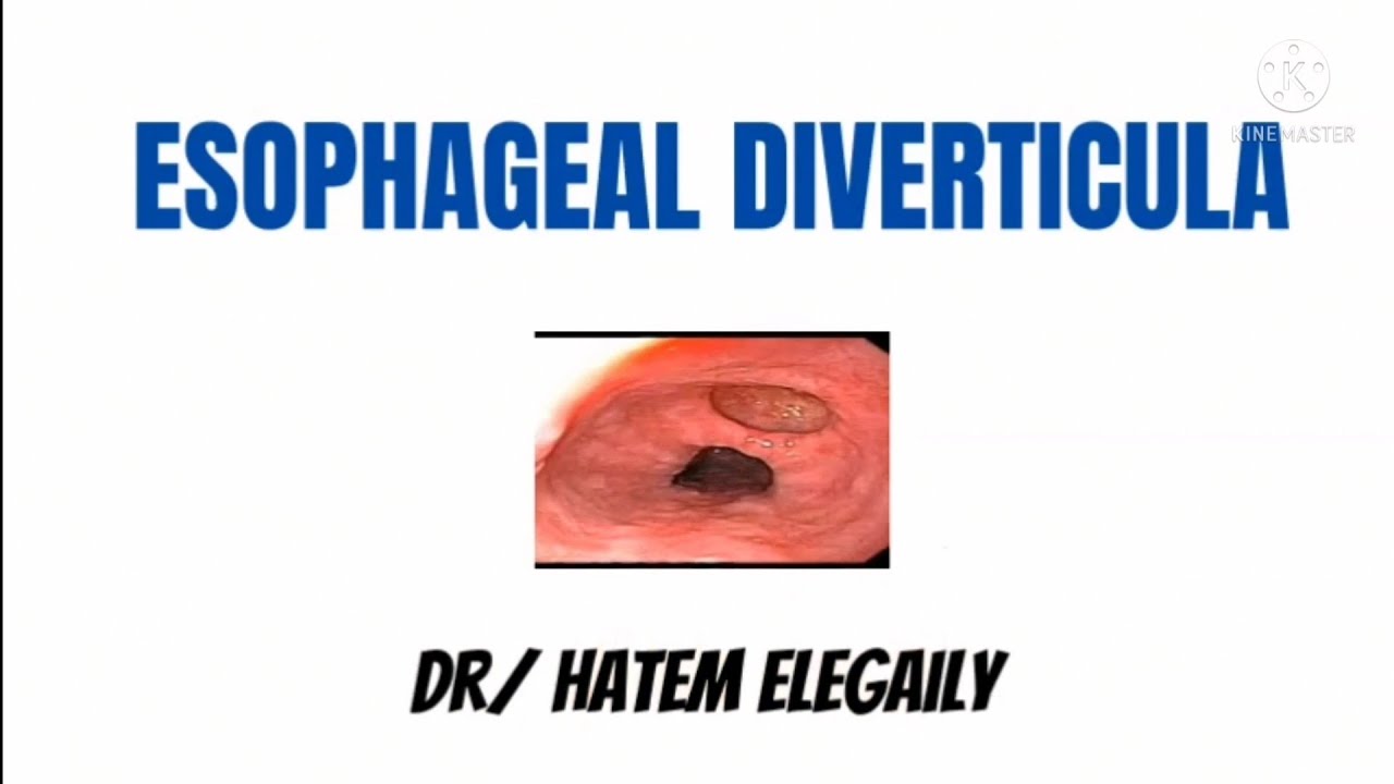Esophageal Diverticula - YouTube
