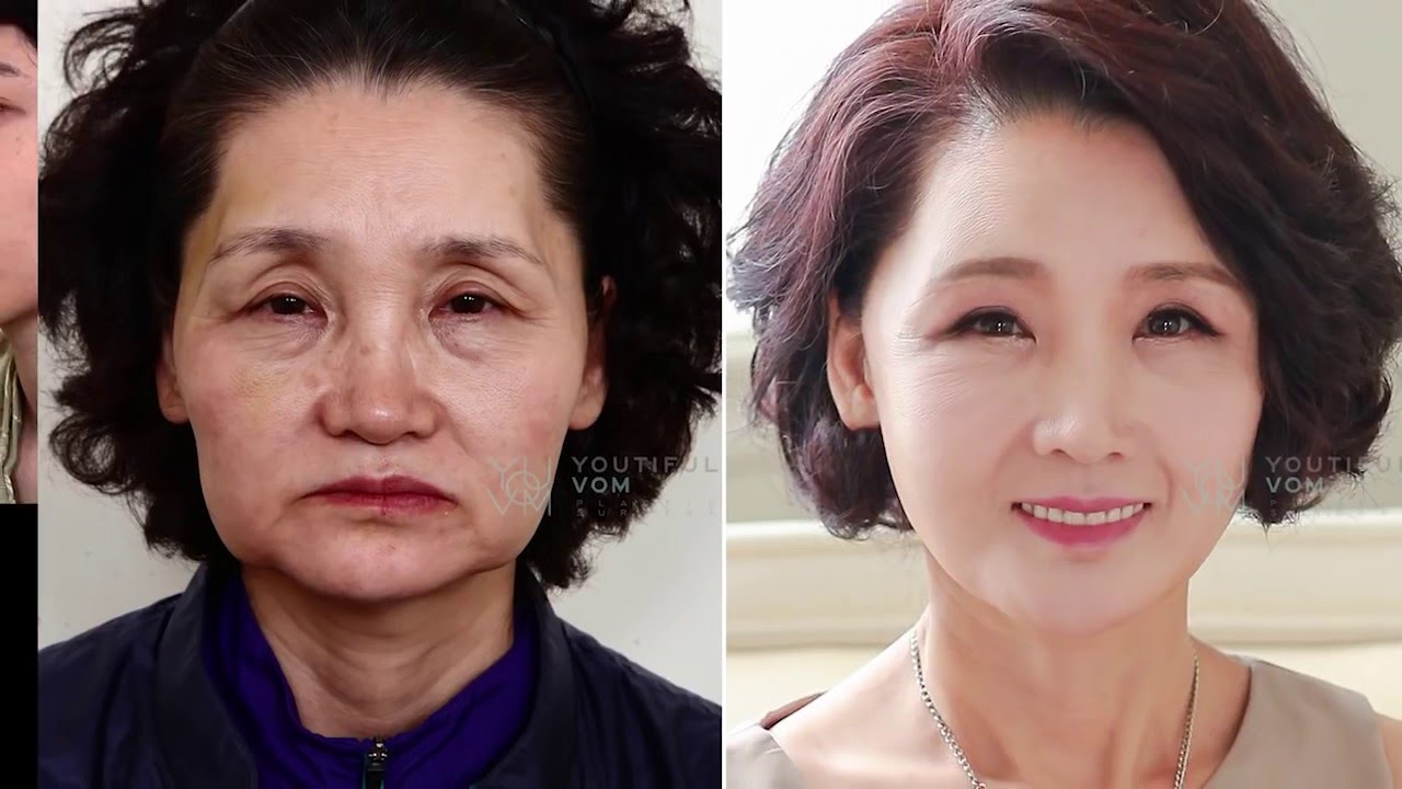 Cirugía Plástica Coreana Antes Y Después 25 Antes Y Después De