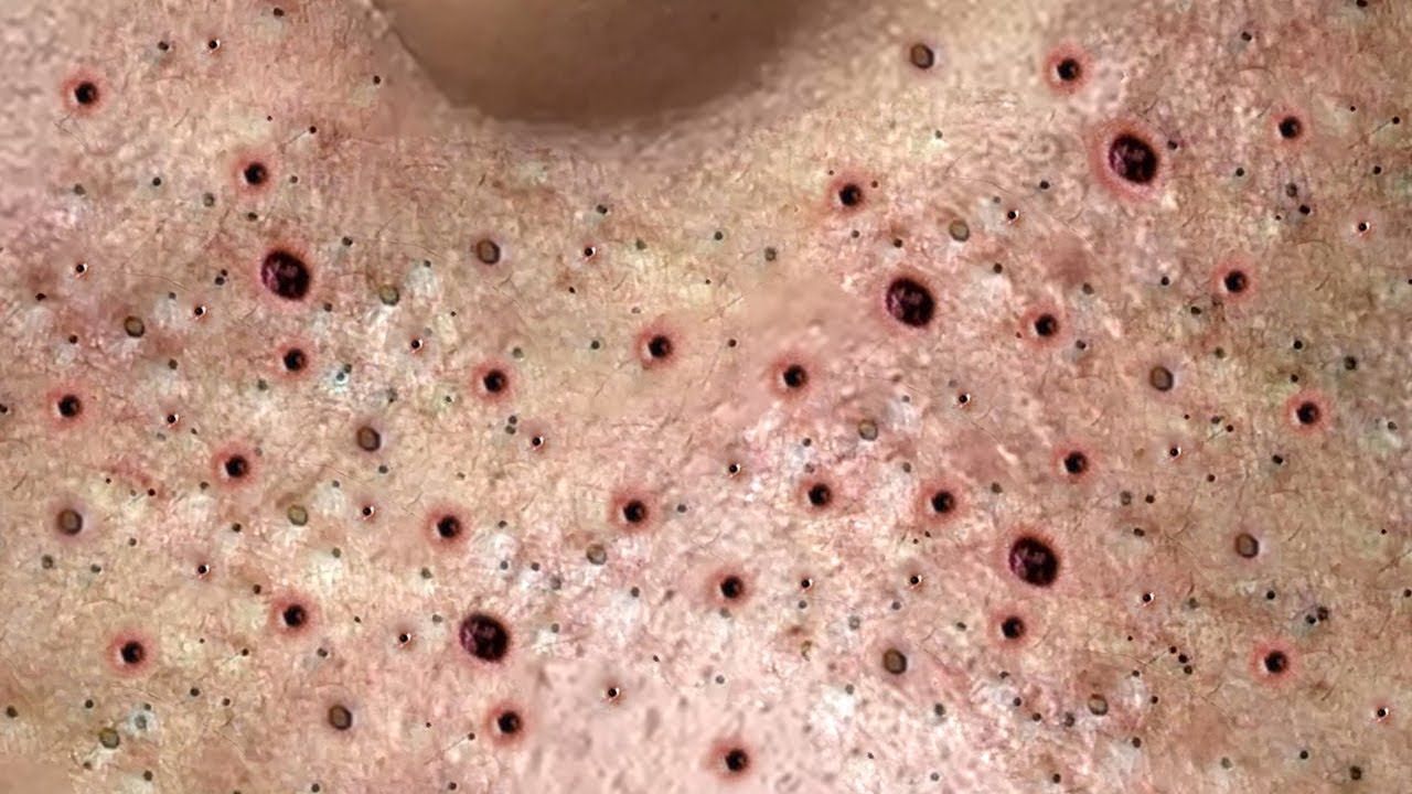 𝐄𝐱𝐭𝐫𝐞𝐦𝐞 𝐁𝐥𝐚𝐜𝐤𝐡𝐞𝐚𝐝 𝐑𝐞𝐦𝐨𝐯𝐚𝐥 𝐚𝐭 𝐋𝐍𝐆 𝐒𝐤𝐢𝐧 𝐂𝐚𝐫𝐞 # 58608 - YouTube