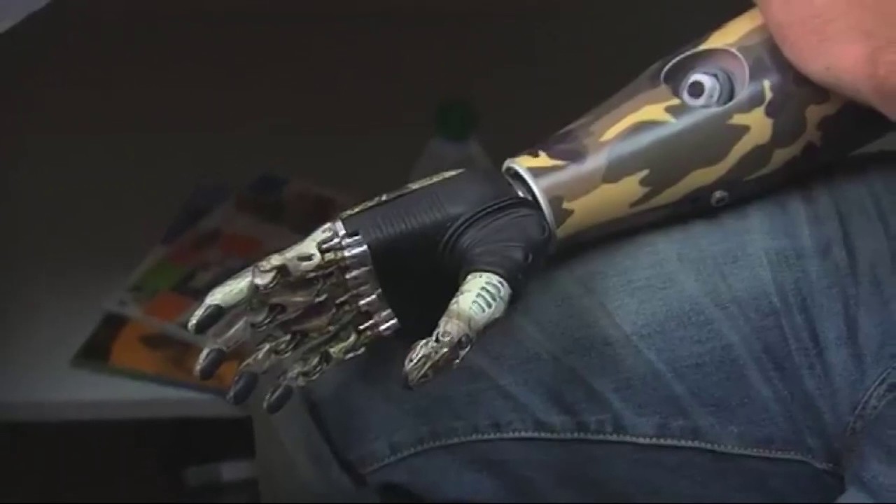 Woman bitten by shark getting prosthetic arm - YouTube