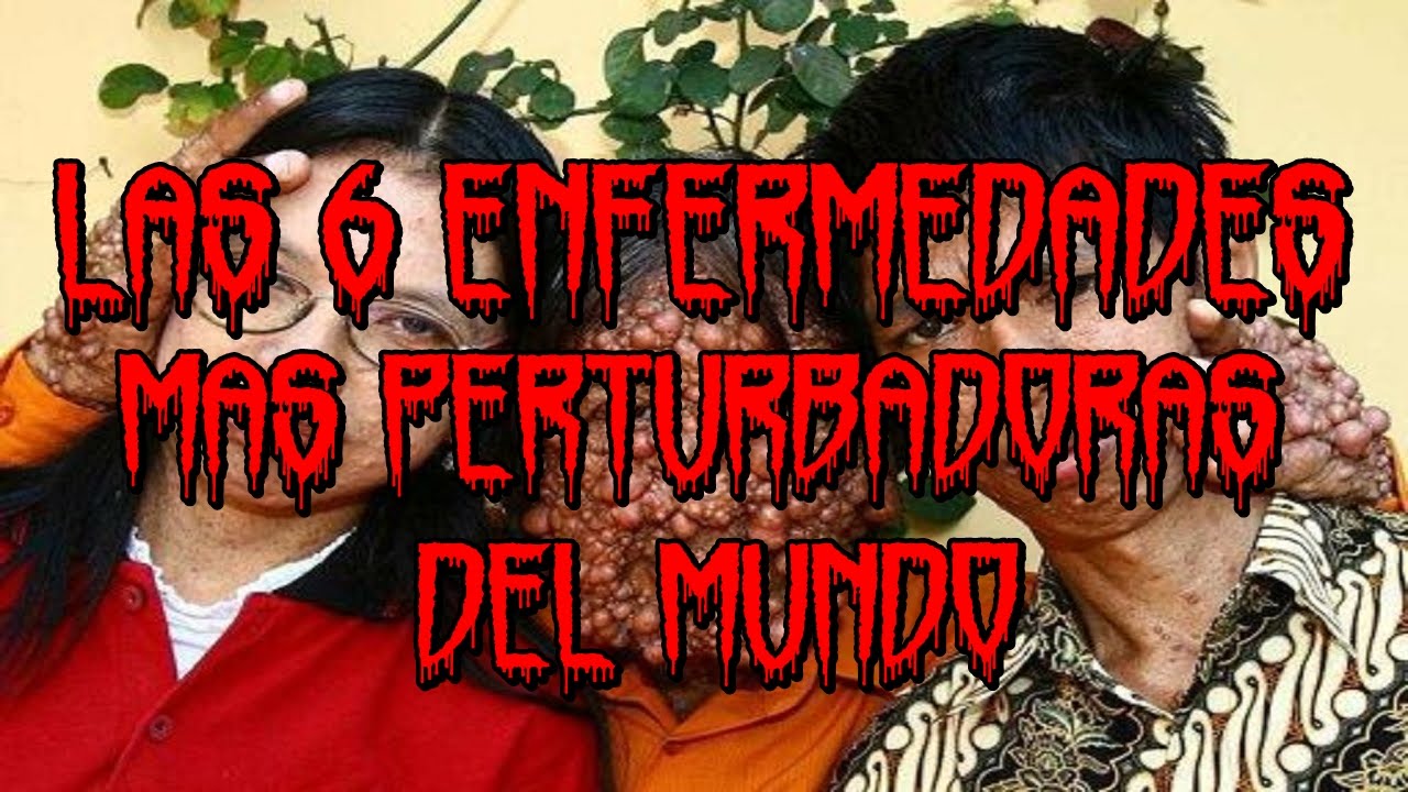 TOP: Las 6 enfermedades más perturbadoras del mundo - YouTube