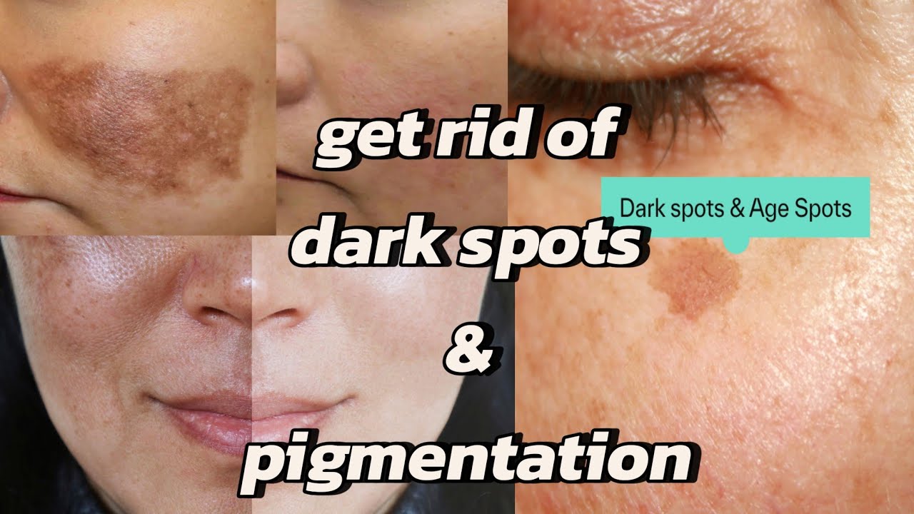 How to Get Rid of Dark spots, pigmentation |Homemade remedy of ...