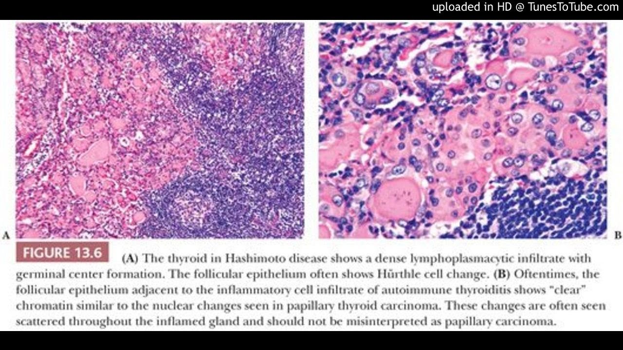 Columnar cell variant of papillary thyroid carcinoma (CCV-PTC) - YouTube