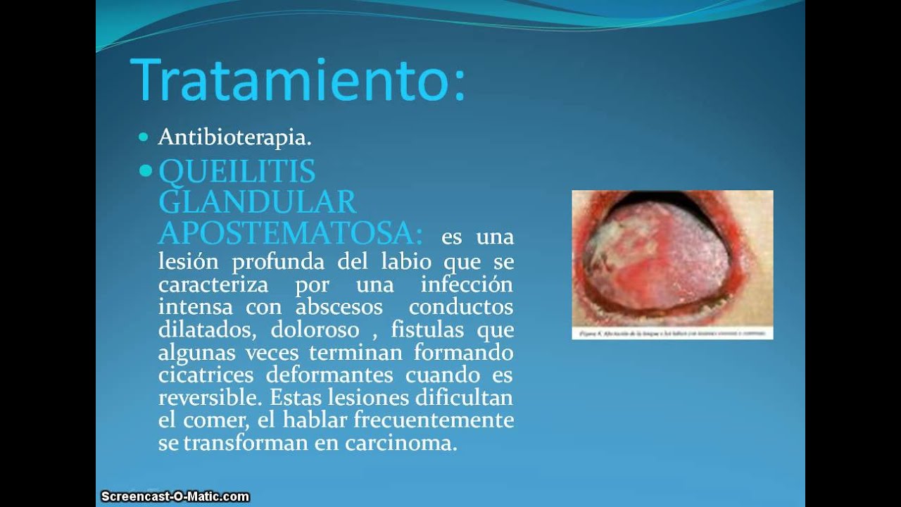 QUEILITIS - YouTube