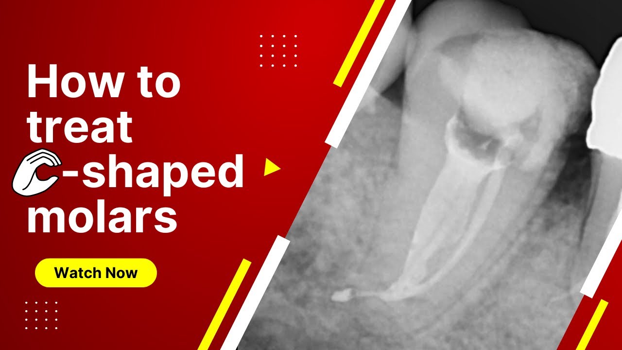 Root canal treatment of a C-shaped mandibular second molar - YouTube