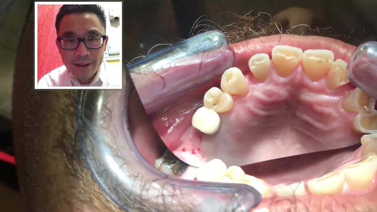 How to do non-invasive single implant placement - YouTube