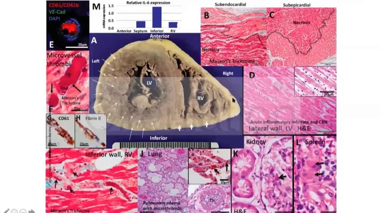Cardiac Injury and PCI in the Era of COVID 19: From Cath Lab to ...