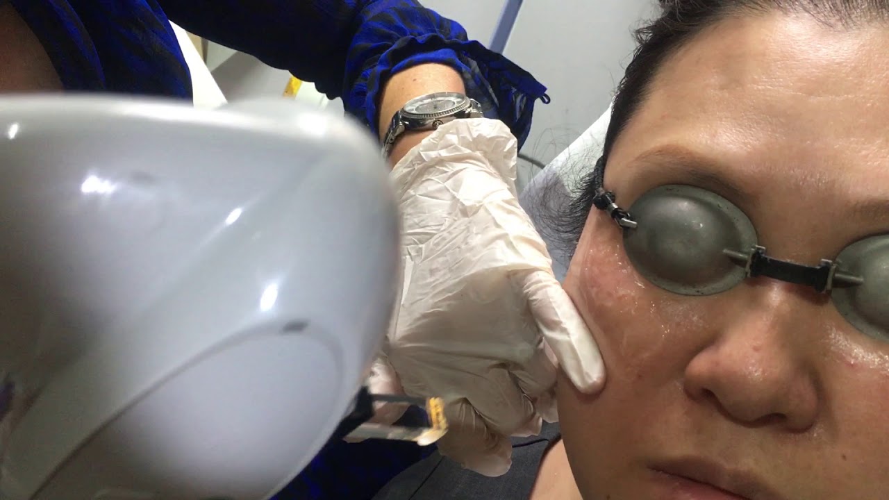 Laser treatment to remove Pigmentation and Brown Spots - YouTube
