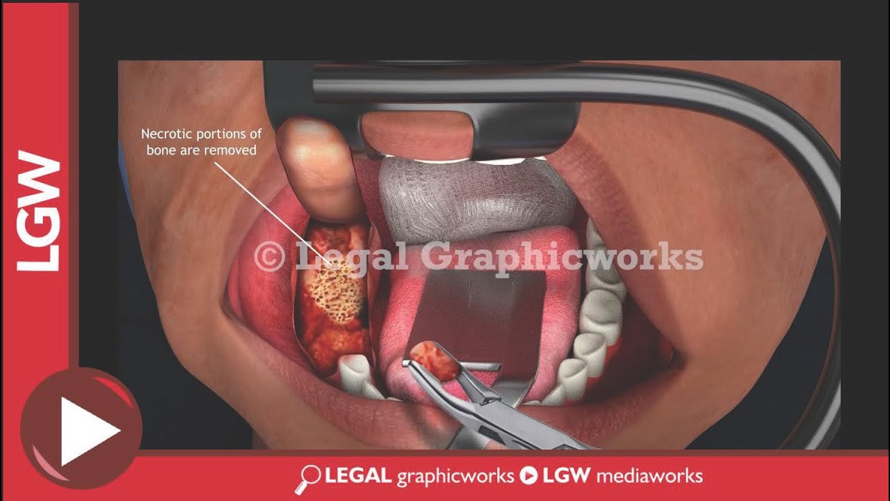 Dental Implant Surgery 3D Animation - YouTube