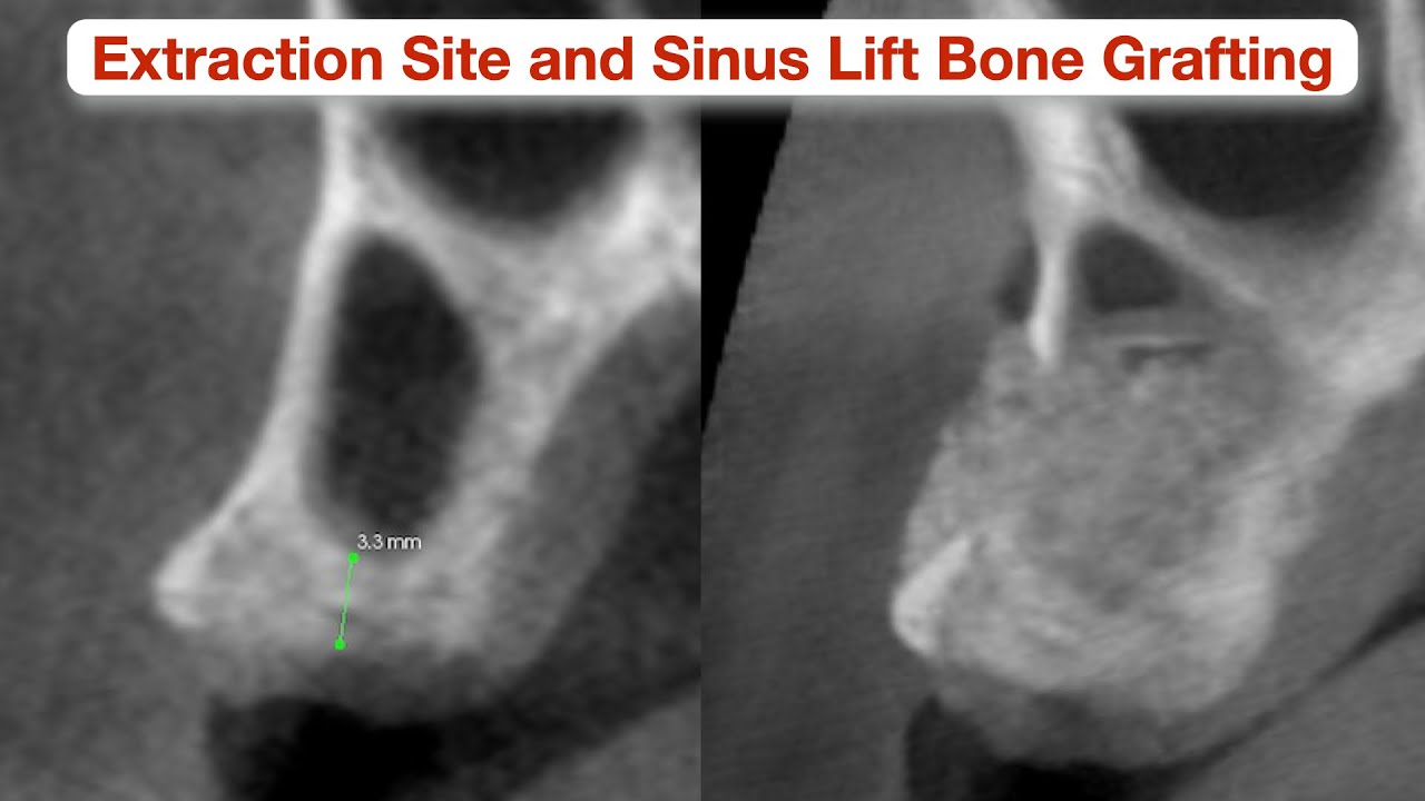 Staged Tooth Extraction & Site Bone Graft and Sinus Lift Bone Graft to ...
