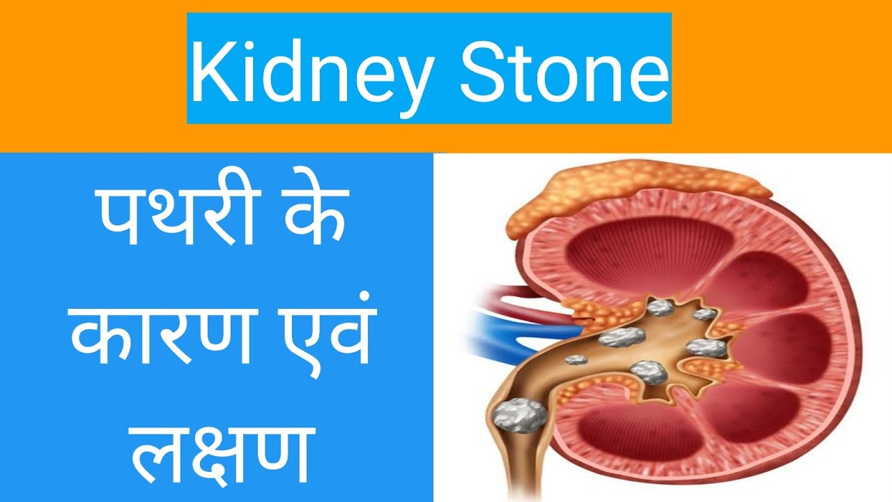 पथरी ( Pathri) के कारण एवं लक्षण / Kidney stone causes & symptoms - YouTube