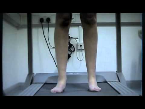 Foot Pronation and Gait Problems - YouTube