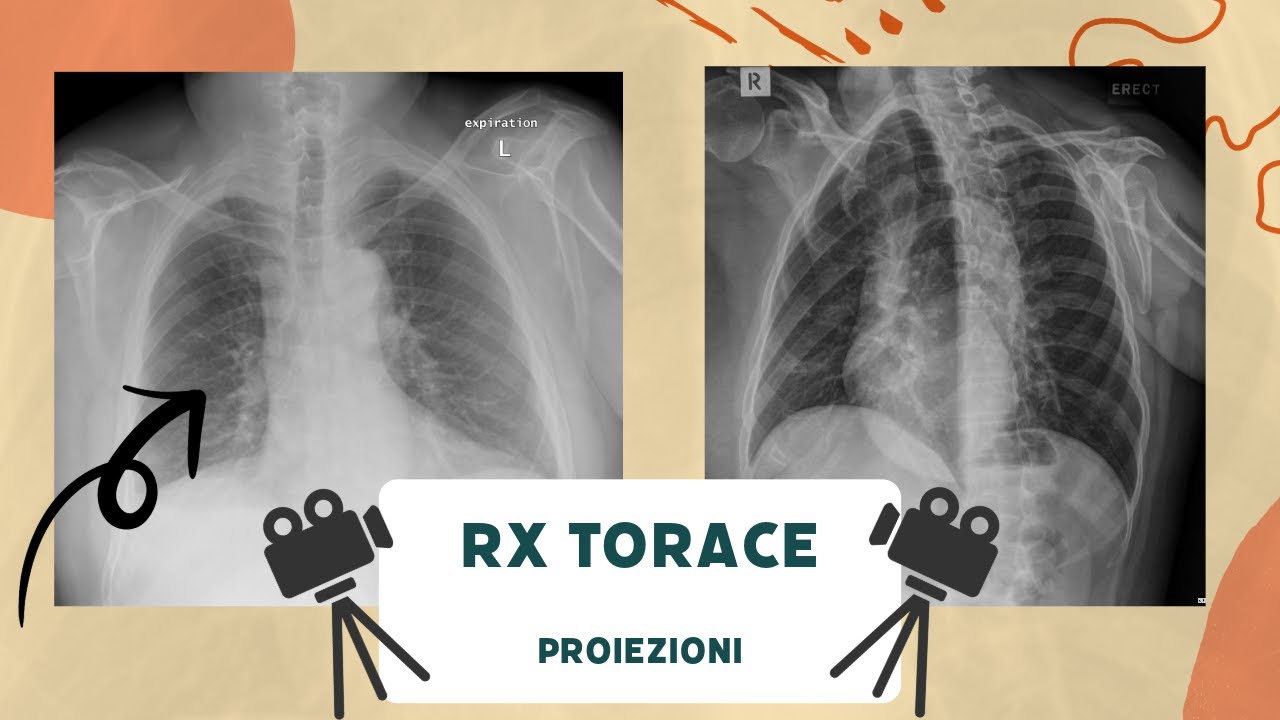 RX del Torace in 120 Secondi: Le Proiezioni - YouTube