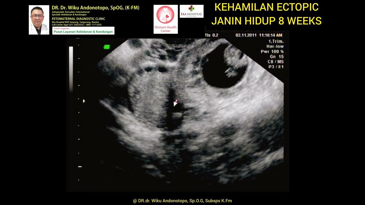 Ectopic pregnancy 8 weeks - YouTube