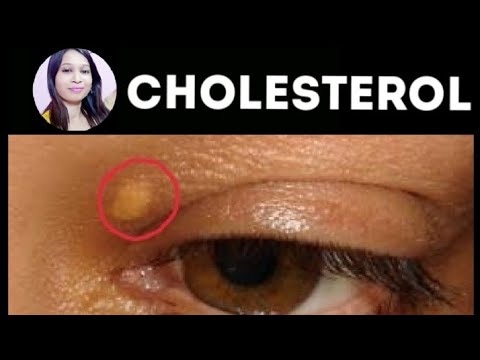How to Remove Cholesterol Deposits Around Eyes ll Xanthelasma ll ...