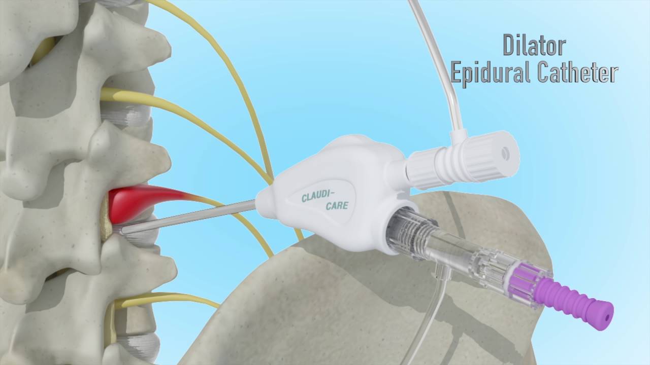 foraminoplasty with claudi-care - YouTube