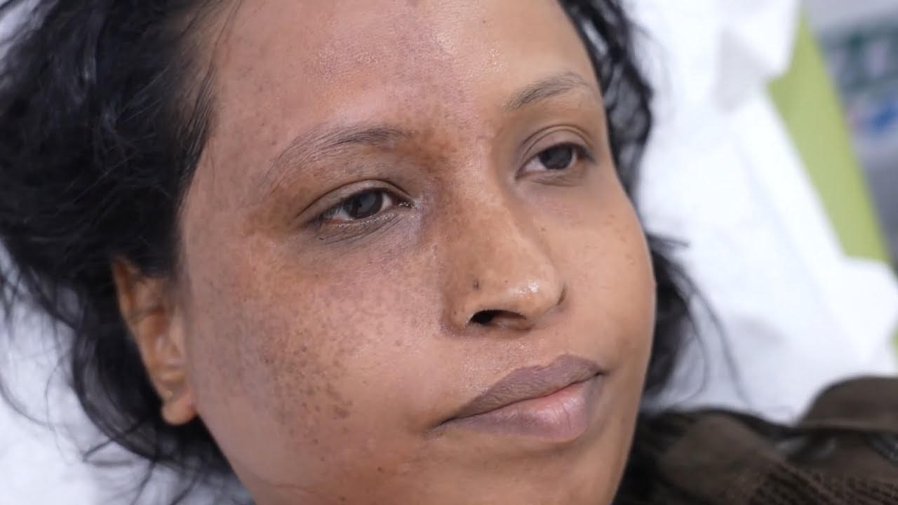 Removing Birthmark on Face | Nevus of Dark Grey Face Birthmark Removal ...