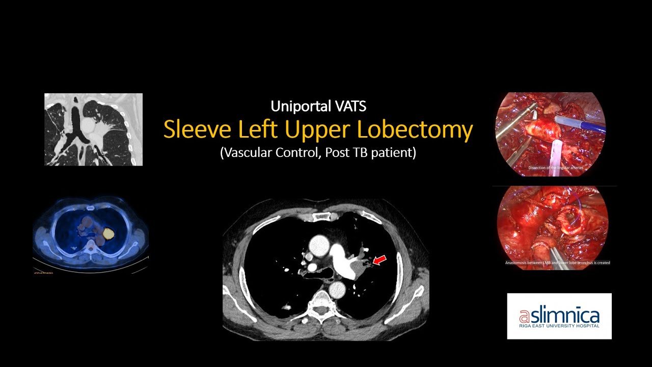 Sleeve Left Upper Lobectomy (Vascular Control, PostTB patient) - YouTube