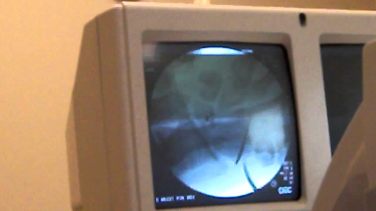 K-wire pin removal in wrist - YouTube
