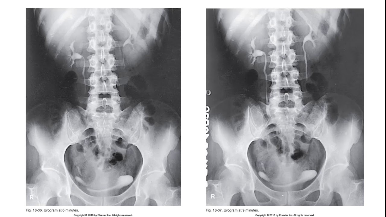 Intravenous Urography - YouTube