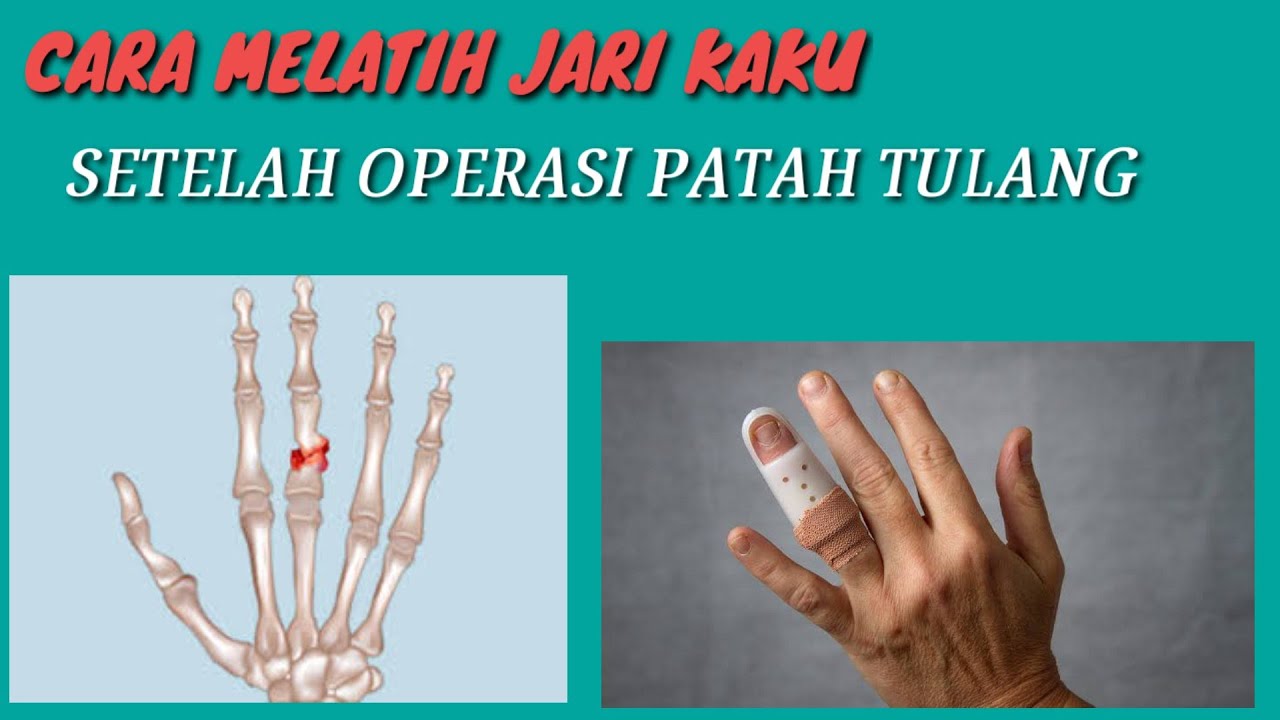 Operasi Patah Tulang Tangan - Homecare24