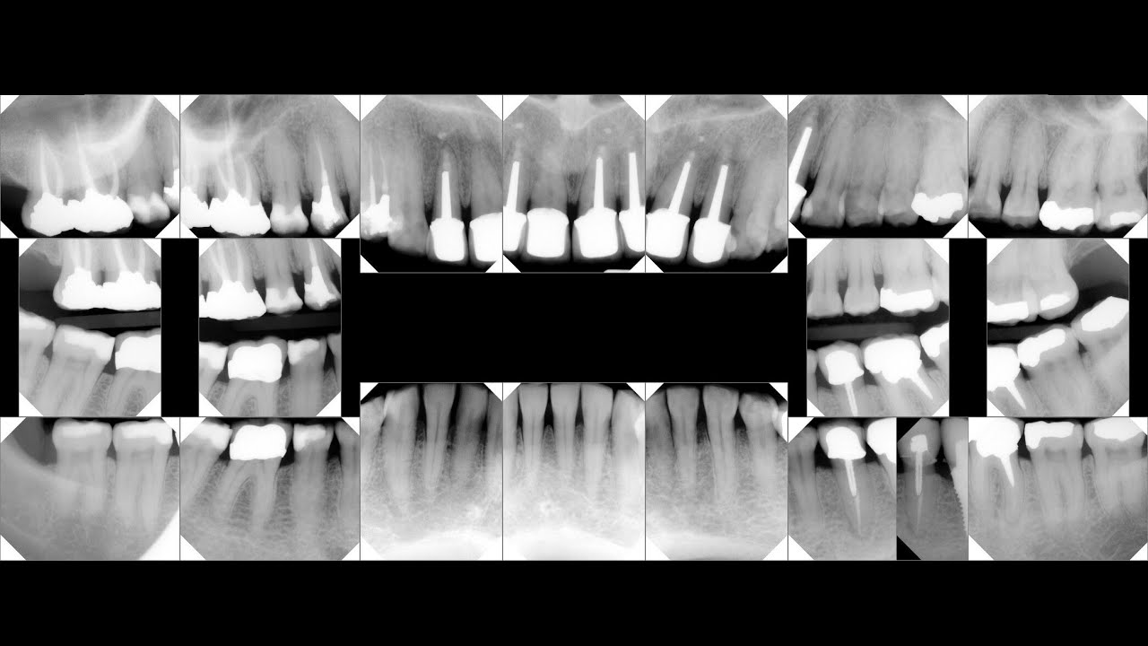 🦷☢Dental X-Ray Rinn Kit Placement (2019) - YouTube
