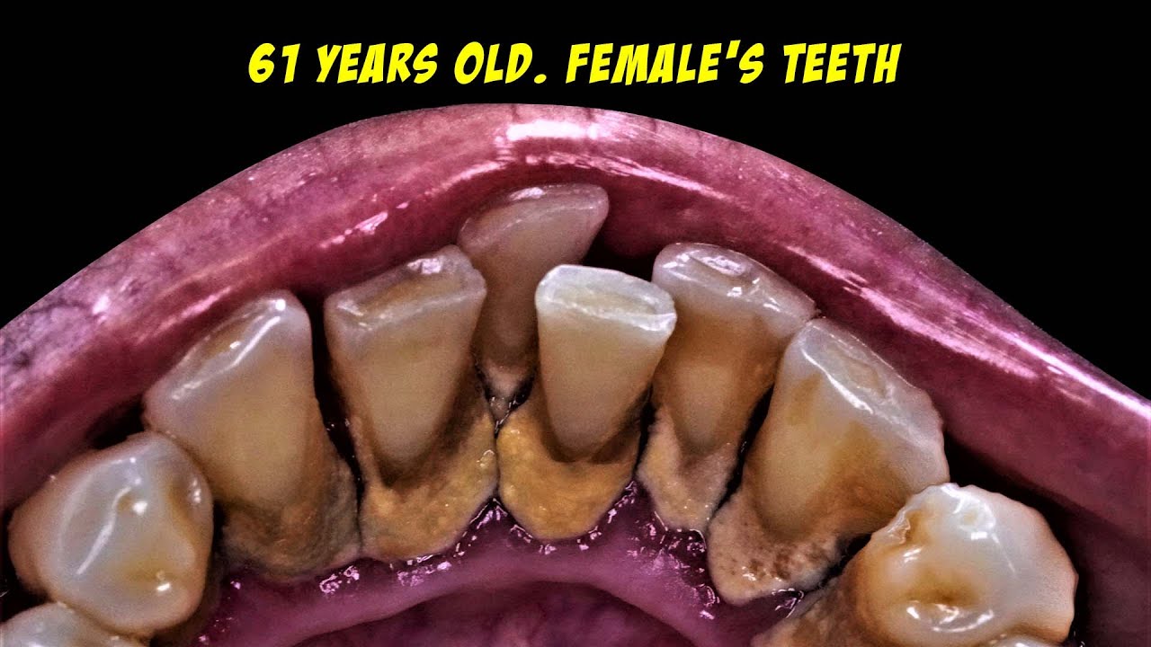 Scaling Routine | Tartar | Dentist | Dokter Gigi Tri Putra - YouTube