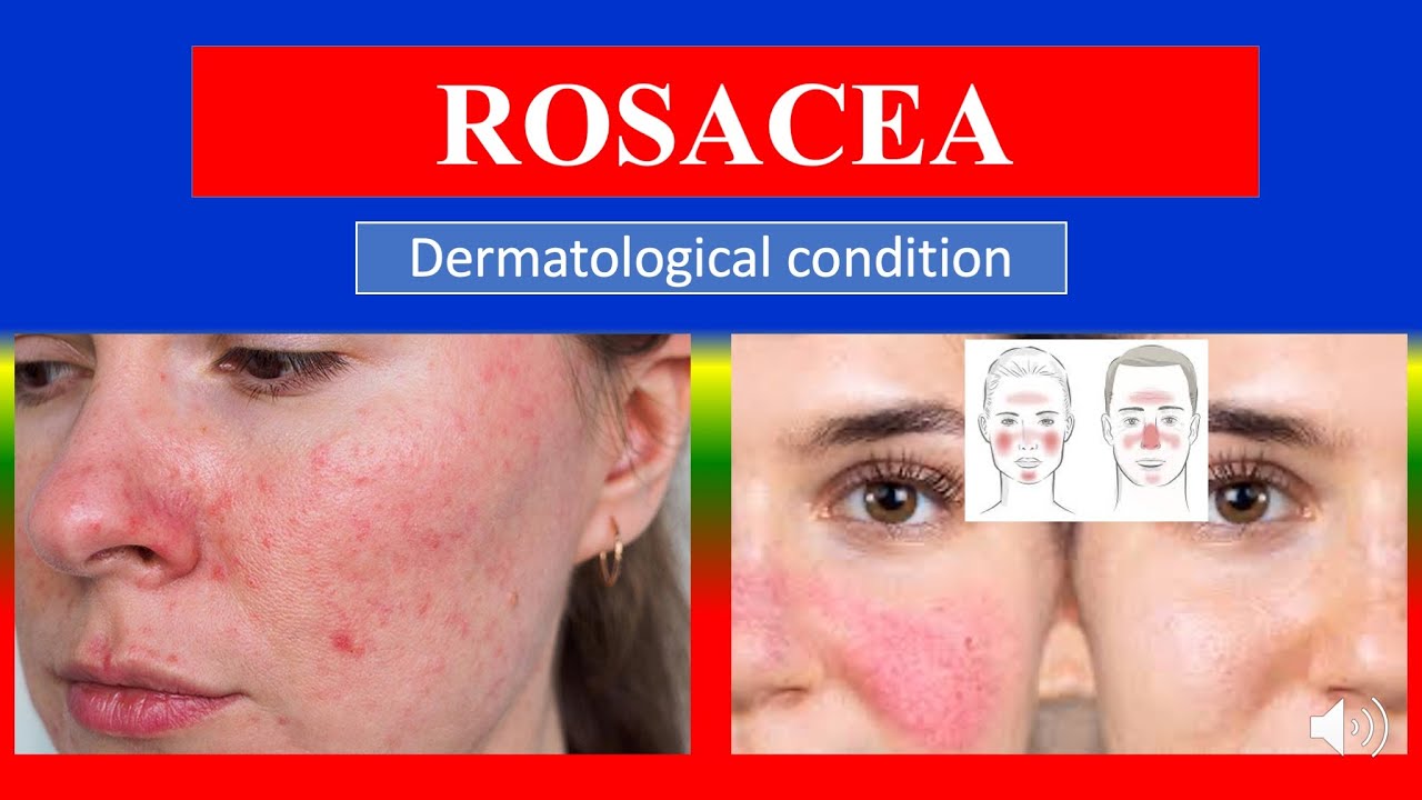 ROSACEA - Definition, types, causes, pathophysiology, signs & symptoms ...