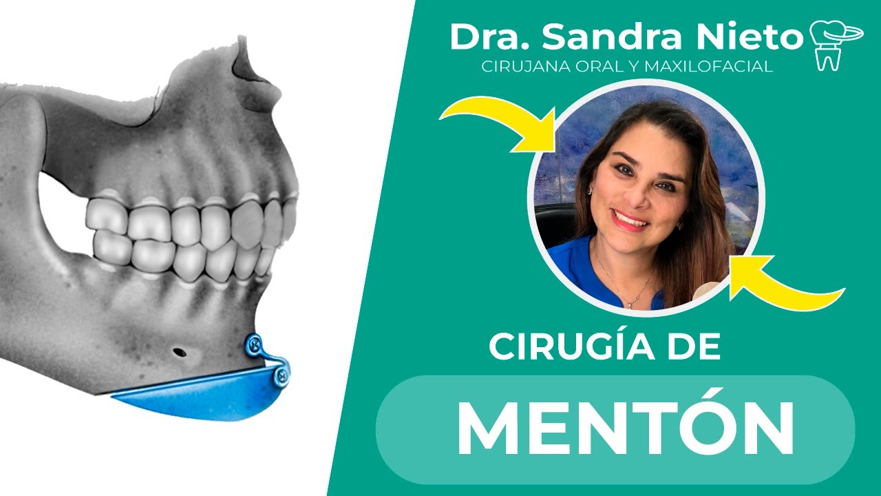 Todo sobre la Mentoplastía o Cirugía de Mentón😊 - YouTube