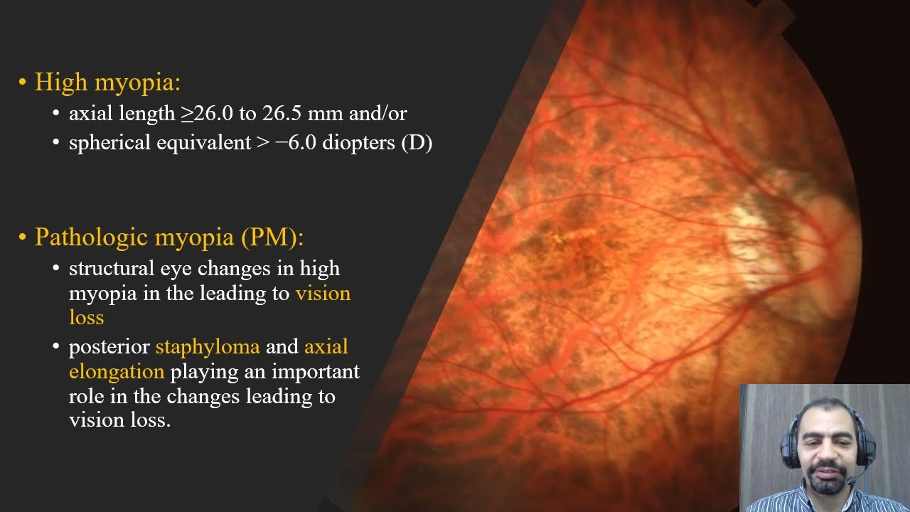 ATN classification of pathological myopia - YouTube